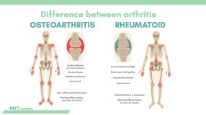 Difference Between Osteoarthritis and Rheumatoid Arthritis | PDcosmetics