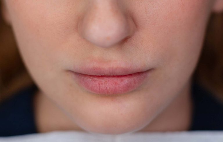 Lip Filler Migration Inside Lip: Understanding Mucosal Bubbles ...