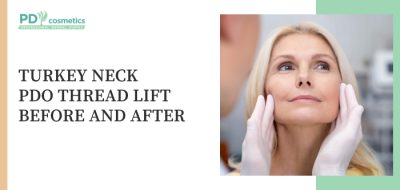 Turkey Neck PDO Thread Lift Before and After - PDCosmetics